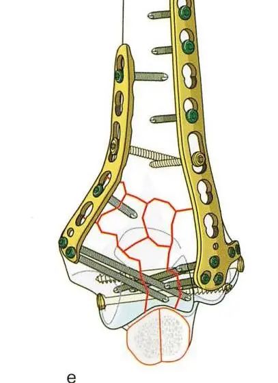 Cómo reparar fracturas de húmero distal usando placas ？ - CzMEDITECH